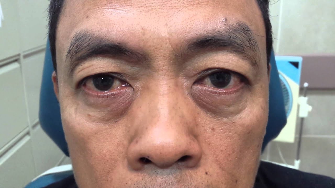 Blepharospasm - YouTube