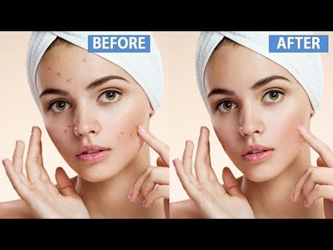 Use Toothpaste and Honey to Get Rid of Acne/Pimples Effectively - YouTube