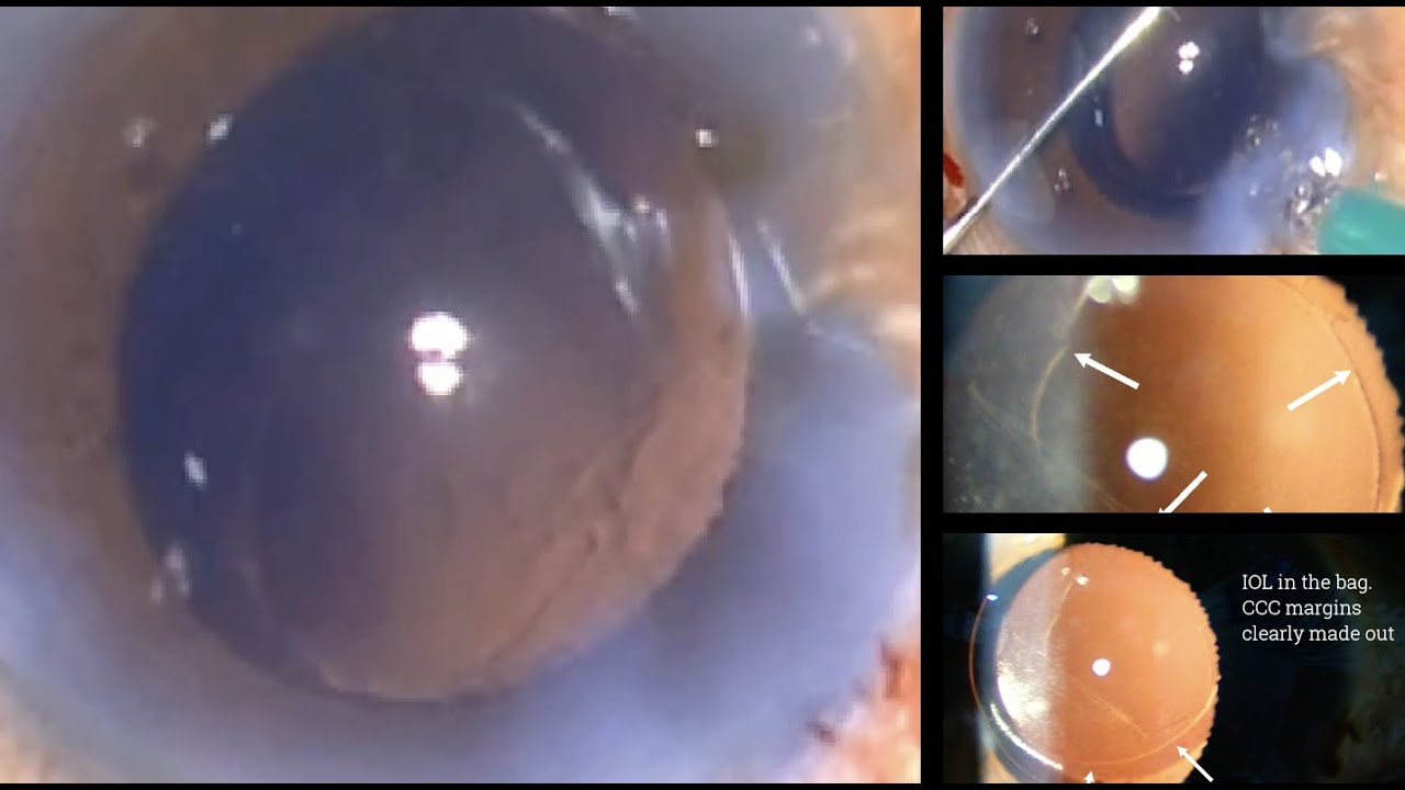 POSTERIOR CAPSULAR RENT WITH INTACT HYALOID FACE DURING PHACO - GENTLE ...