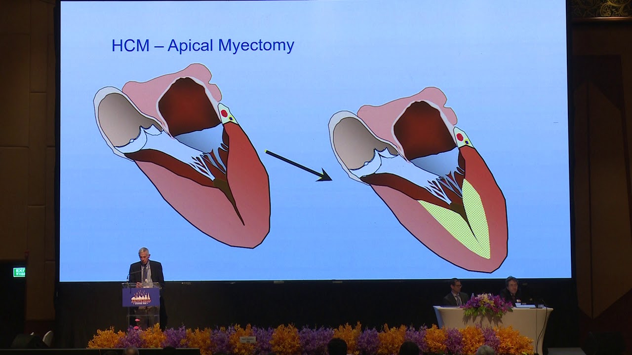ASCVTS 2020 Surgery for HOCM - YouTube