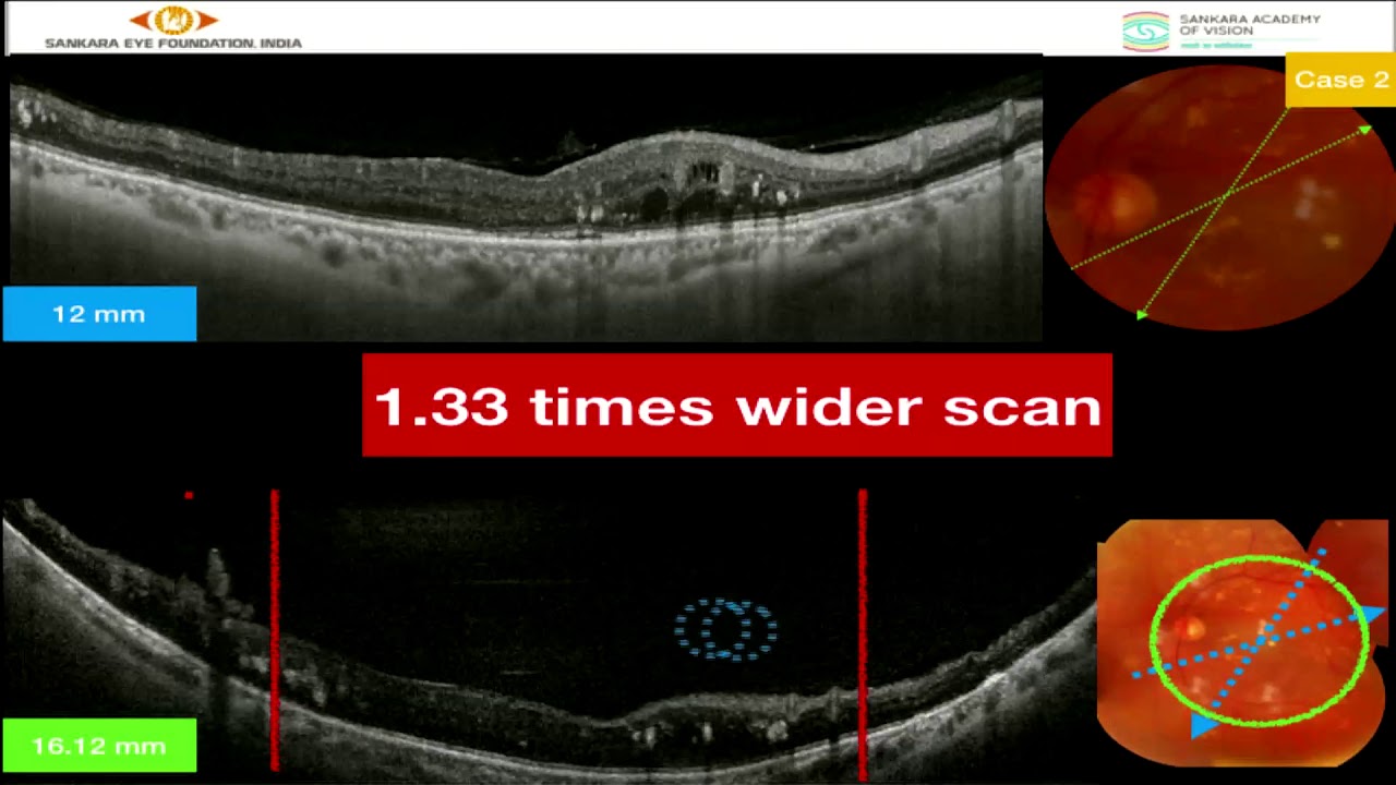 AIOC2018 - Vitreo Retinal Diseases Semi finals - YouTube