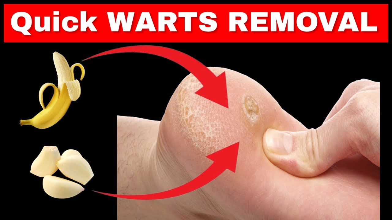 Wart Removal: How to get rid of plantar warts PERMANENTLY at Home ...