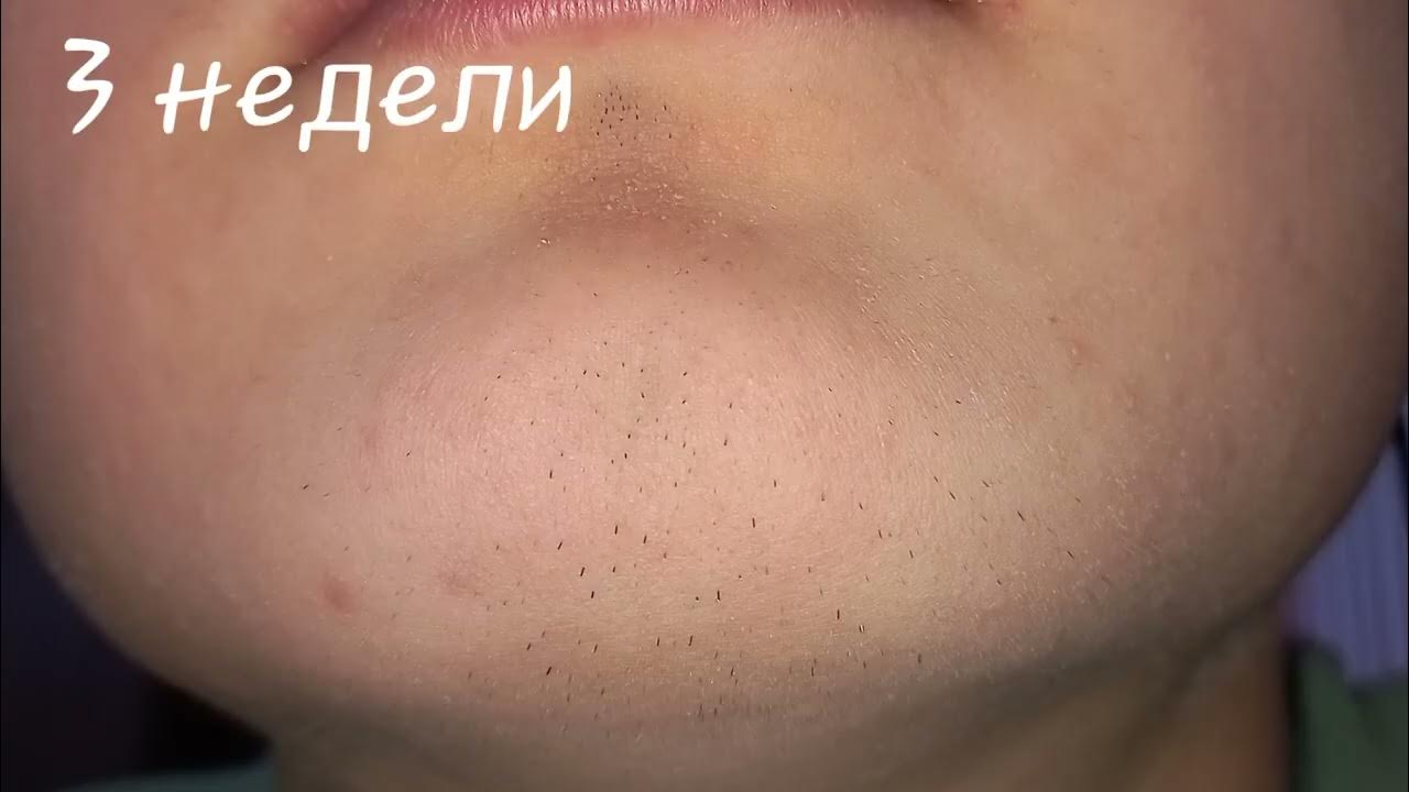 МИНОКСИДИЛ 5% / РЕЗУЛЬТАТЫ МИНОКСИДИЛ / МИНОКСИДИЛ ДЛЯ БОРОДЫ / БОРОДА ...