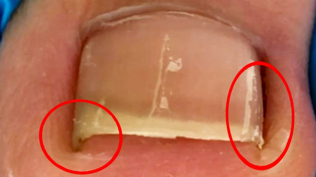 Sharp ingrown toenails, perfectly trimmed【Crazy pedicure room】 - YouTube