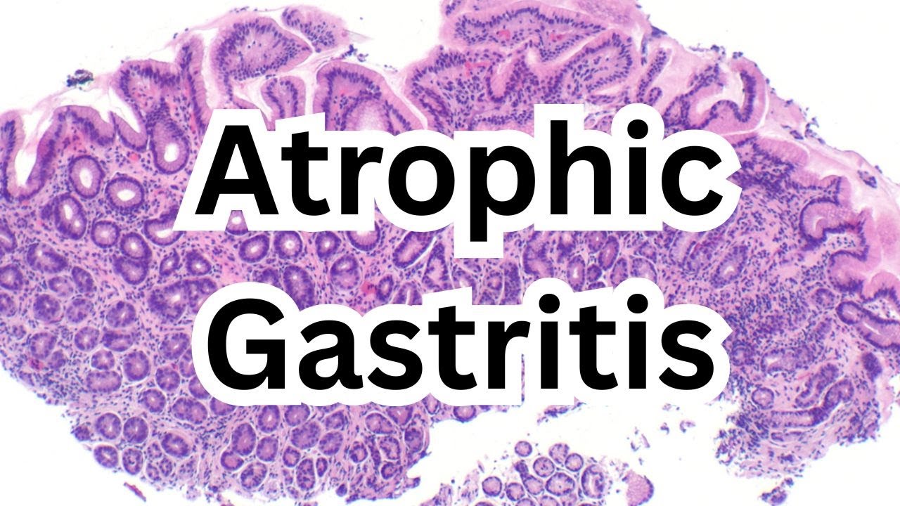 What is Atrophic Gastritis? - YouTube