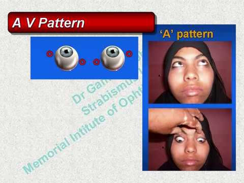 A V pattern - YouTube