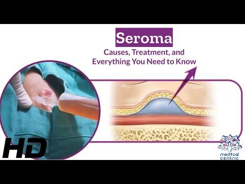 How To Relieve Seroma Pain