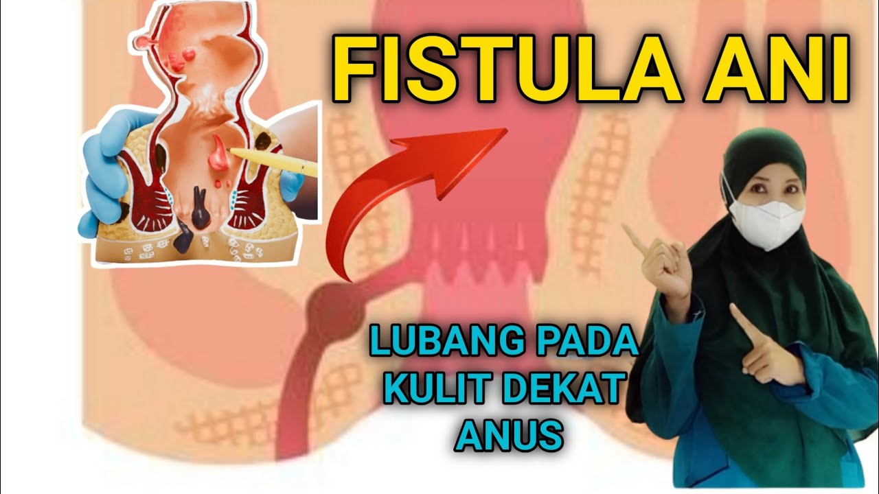 FISTULA ANI . KOMPLIKASI DARI ABSES PERIANAL - YouTube