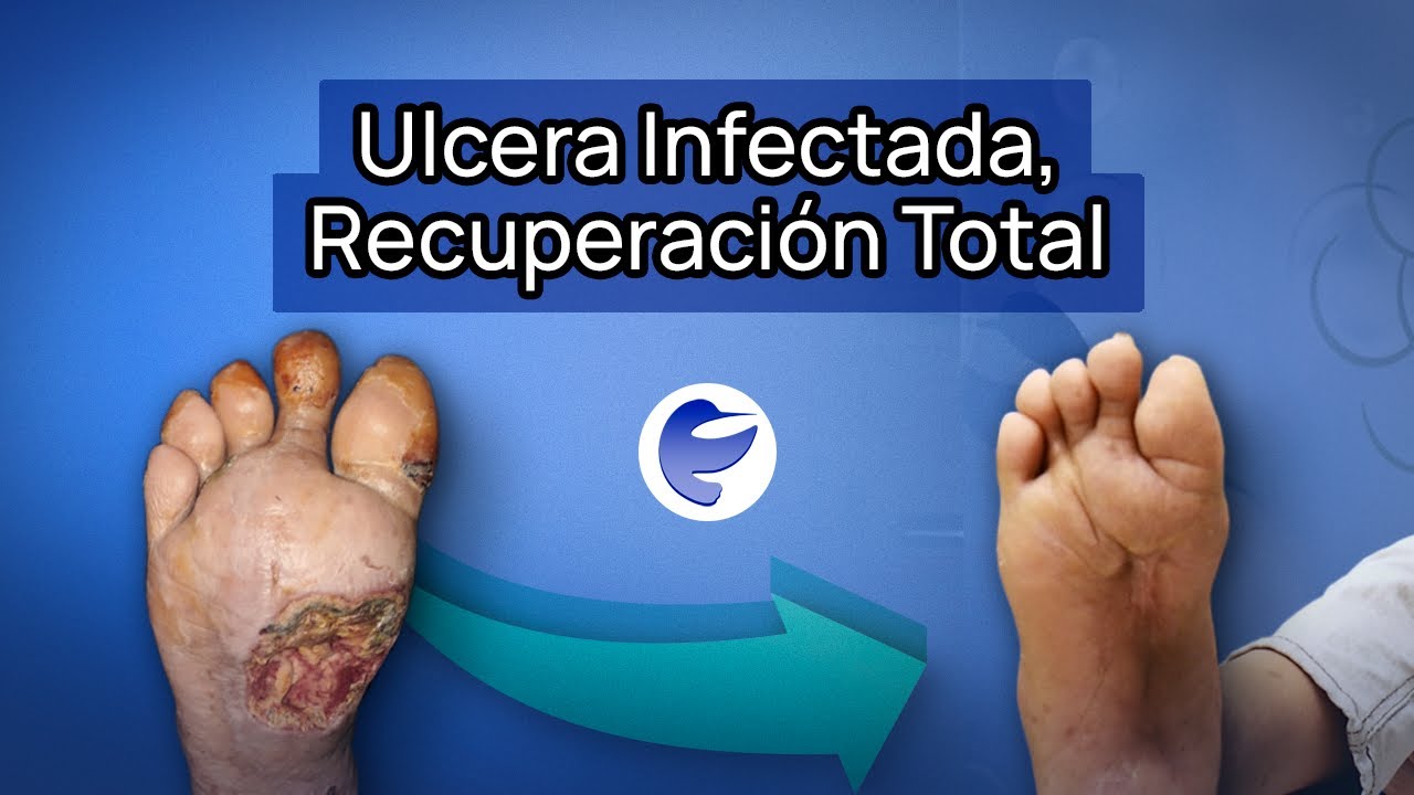 Recuperación total de úlcera infectada - YouTube