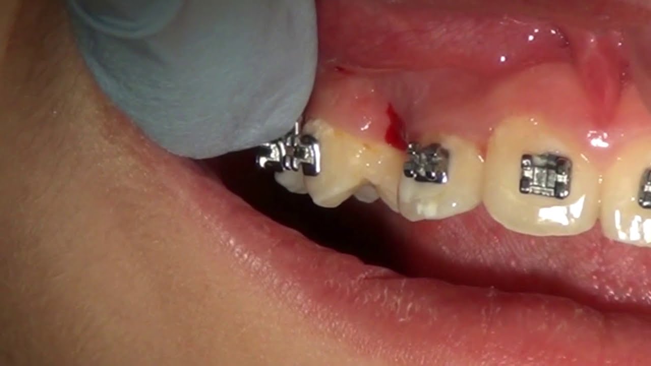 Baby Tooth Removal Method. Los Angeles - 818.776.0055 - YouTube