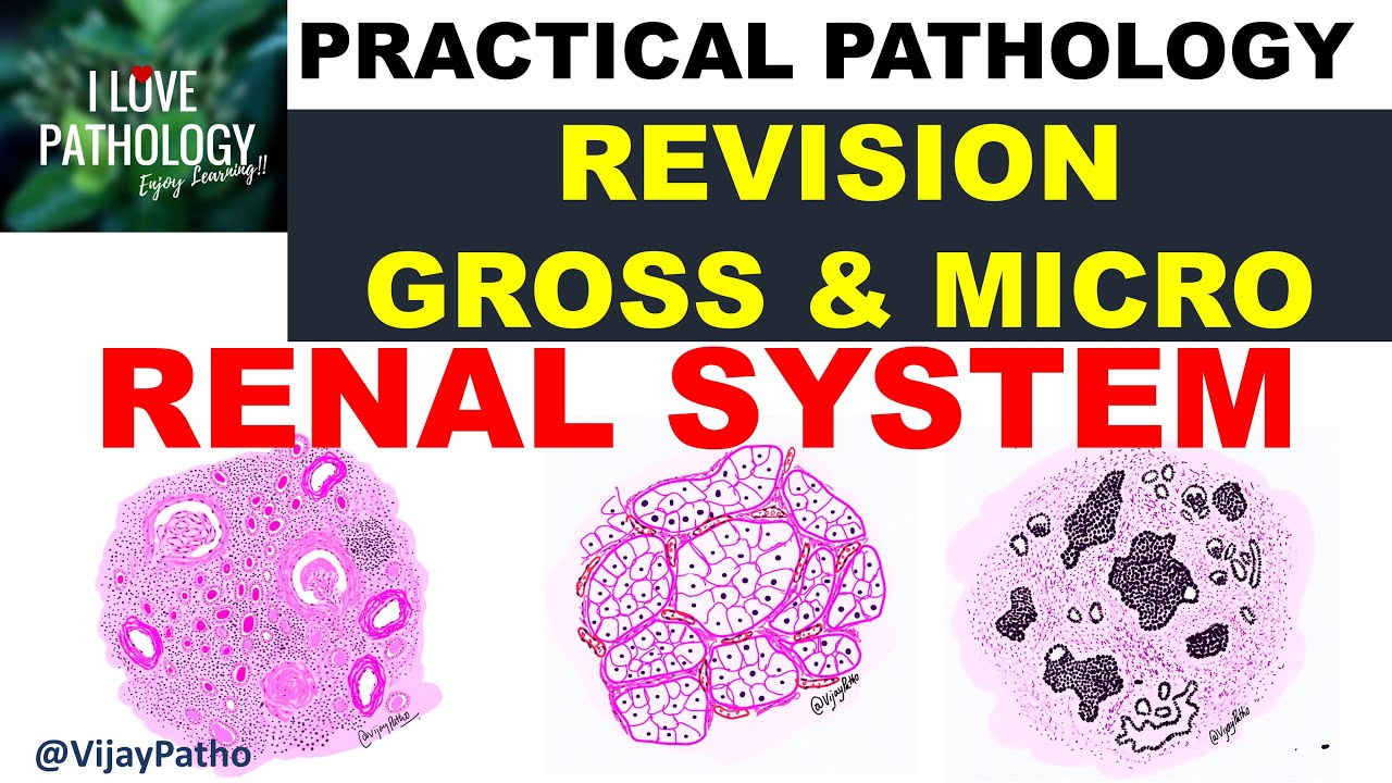 Practical Pathology: Renal system- Chronic pyelonephritis, RCC & Wilms ...