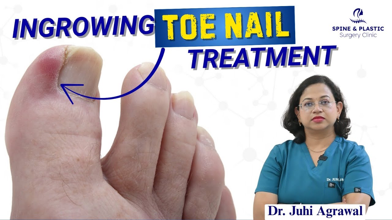 INGROWING TOE NAIL TREATMENT - YouTube