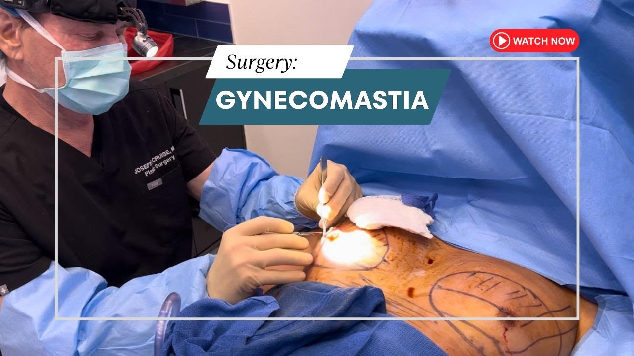Gynecomastia Surgery - Tissue Removal - YouTube