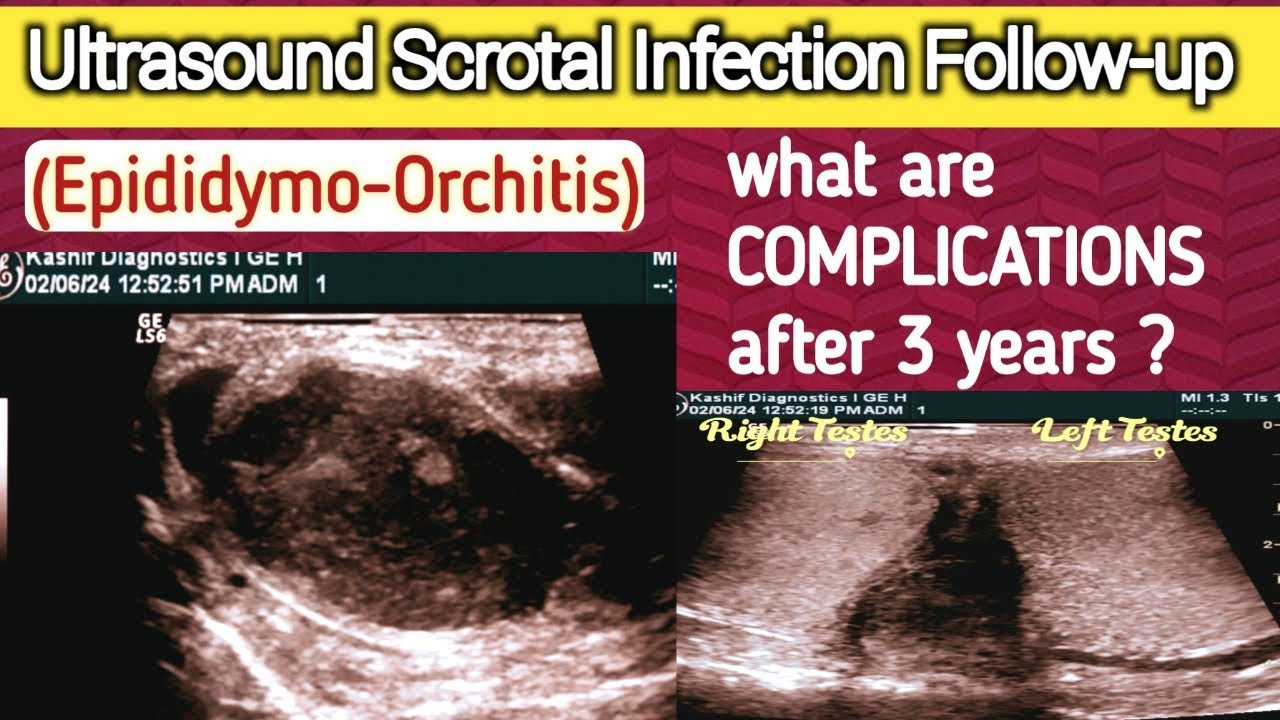 Chronic Scrotal Infection Complications Male Infertility