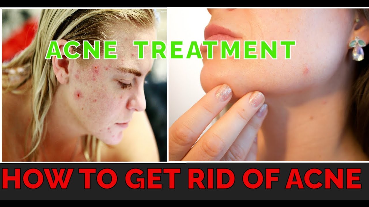 "Quick and Easy Acne Treatment Tips That Actually Work!" #AcneTreatment ...