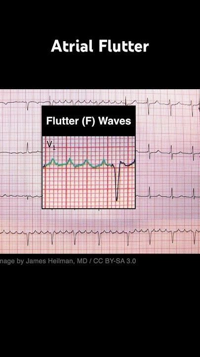 Atrial Flutter ECG: Flutter (F) waves - YouTube