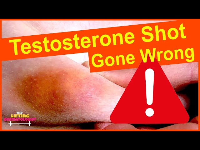 Testosterone Injections Sites