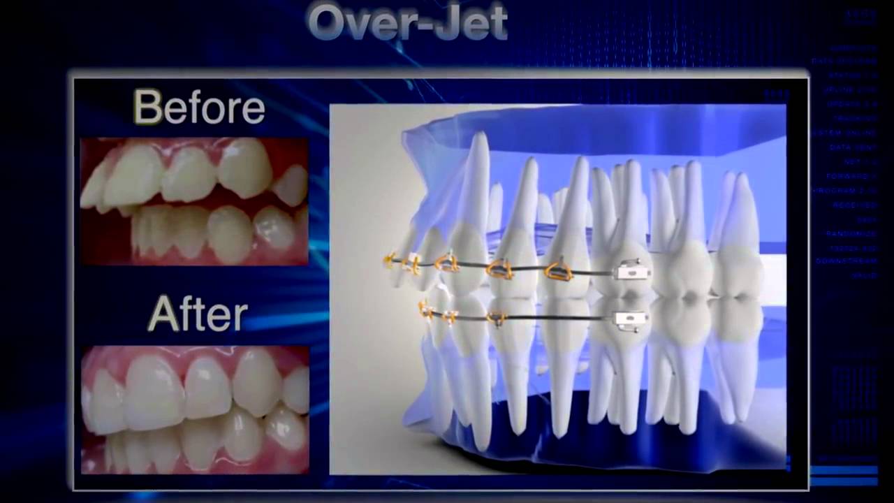 Fastbraces® Before and After Gallery - YouTube