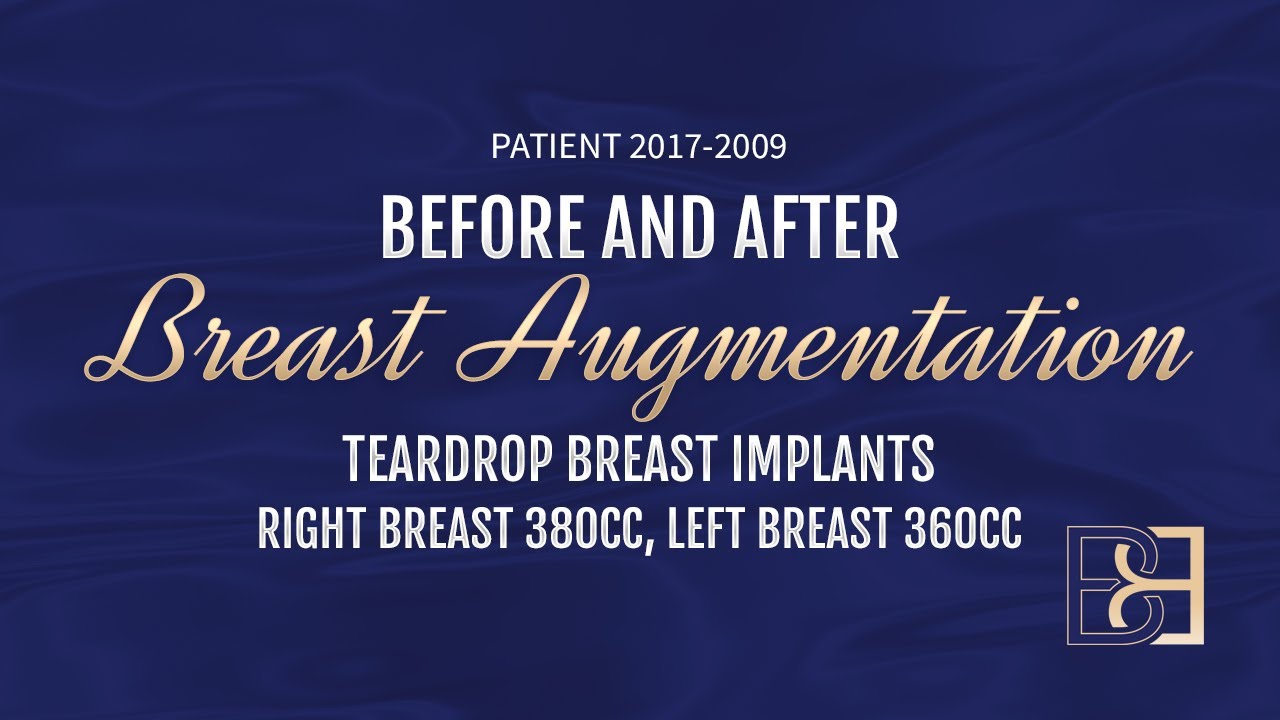 Uneven Breasts Managed with Difference Sized Breast Implants {Patient ...