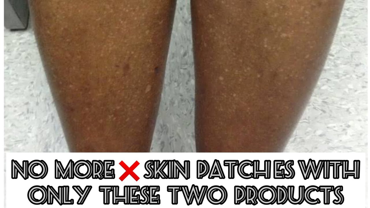 How to Clear WHITE SPOTS | White patches | Cream reaction with Only Two ...