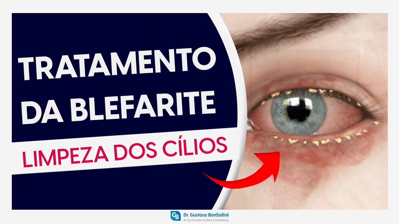 Como limpar os cílios das pálpebras? Tratamento da blefarite - Dr ...
