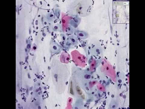 Histopathology Cervix --Low grade squamous intraepithelial l - YouTube