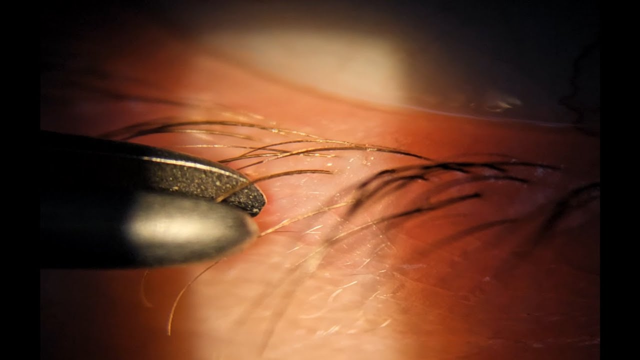 Learning Epilation - YouTube