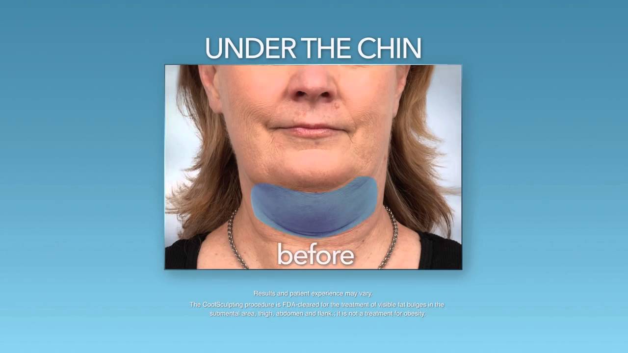 Eliminate your double chin with CoolSculpting! - CoolMini - Upland, CA ...