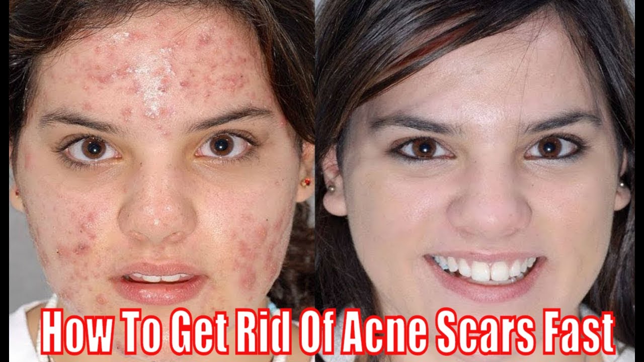 How To Get Rid Of Acne Scars Fast - Using Natural Remedies - YouTube