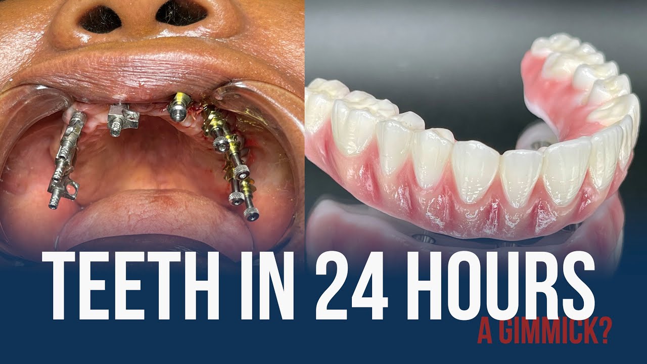 Must Watch! TEETH IN 24 HOURS is a gimmick! - YouTube