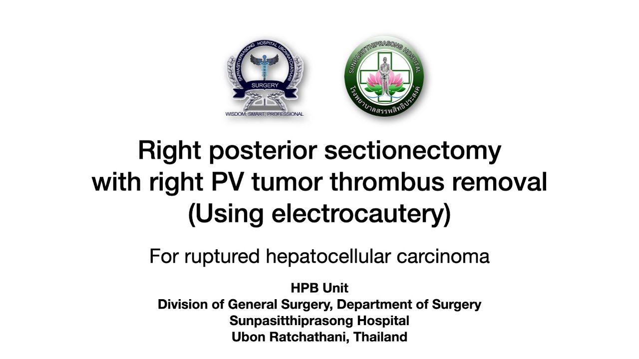Right posterior sectionectomy with right PV tumor thrombus removal for ...