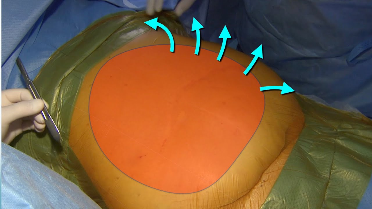 ABDOMINAL WALL RECONSTRUCTION FOR MICKEY MOUSE RECURRENCE AFTER ...