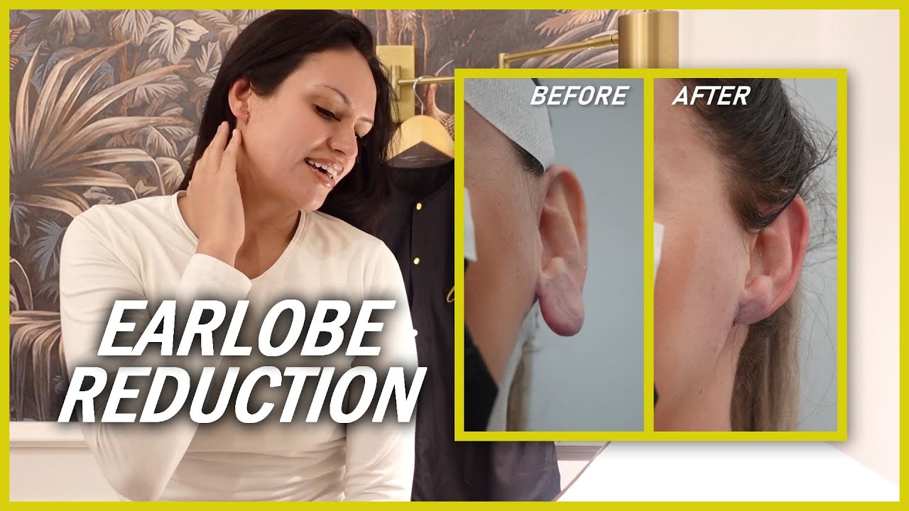 Earlobe Reduction Surgery (Ear Reduction) #earsurgery - YouTube