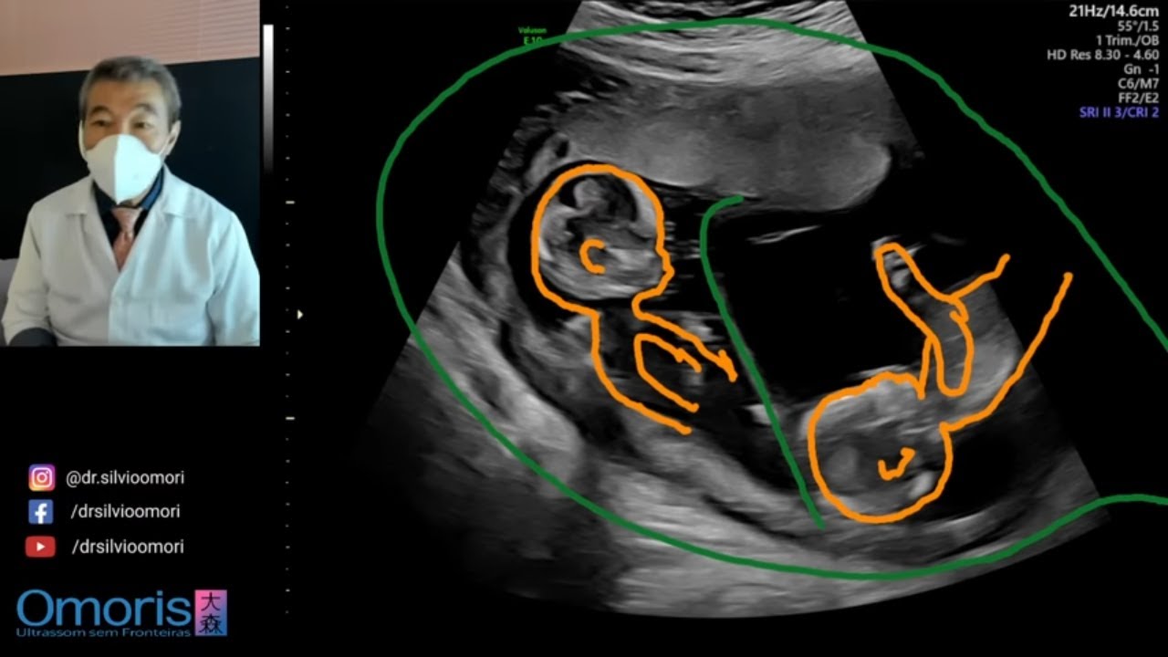 Surpresa! Gêmeos e um Casalzinho: A Emoção da Descoberta na ...
