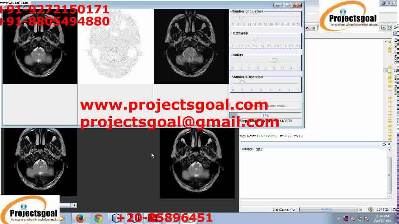 Fuzzy Local Gaussian Mixture Model for Brain MR Image Segmentation new - YouTube