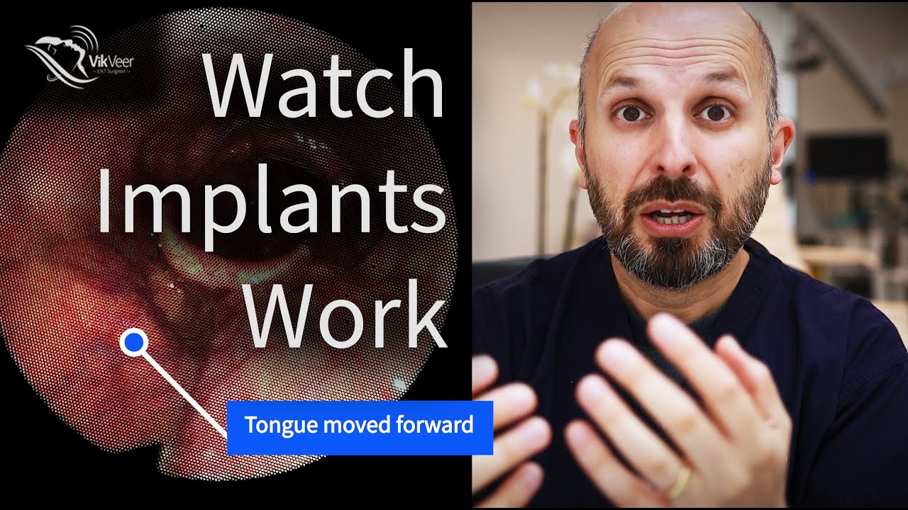 Watch What the Inspire Implant Actually Does Inside Your Throat - YouTube