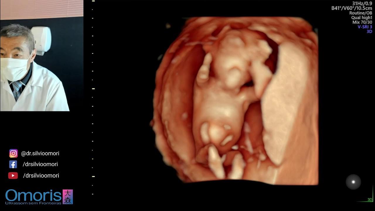 Menino ou menina? Gravidez 14 semanas! - YouTube