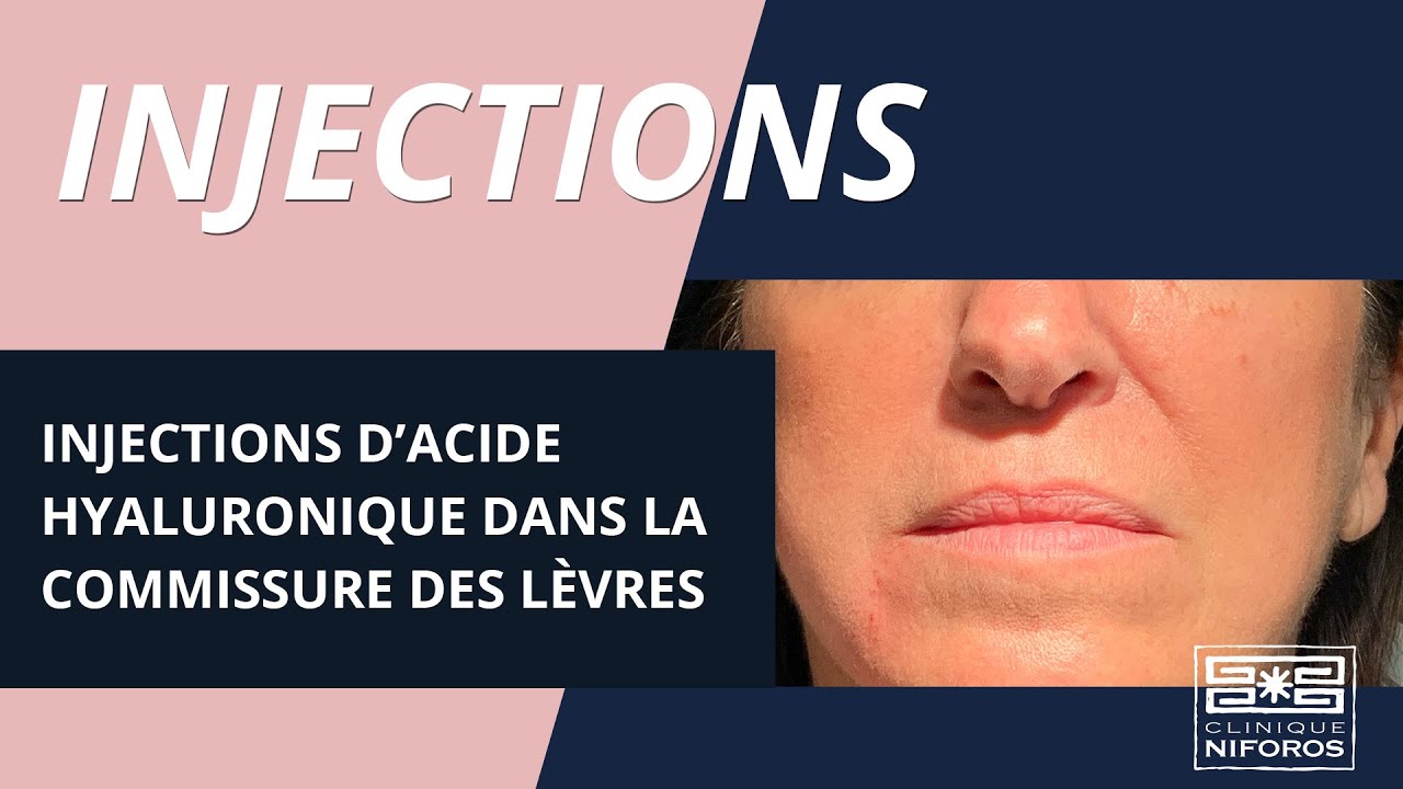 Injections d'acide hyaluronique dans la commissure des lèvres pour ...