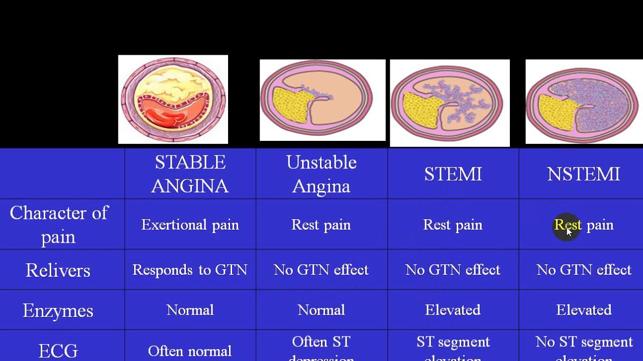 ACS UA NSTEMI STEMI 4TH - YouTube