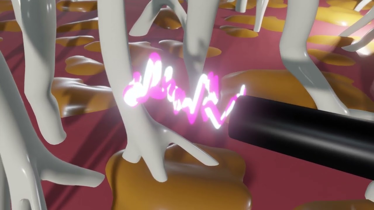 ARGO Plasma Patientenvideo - YouTube