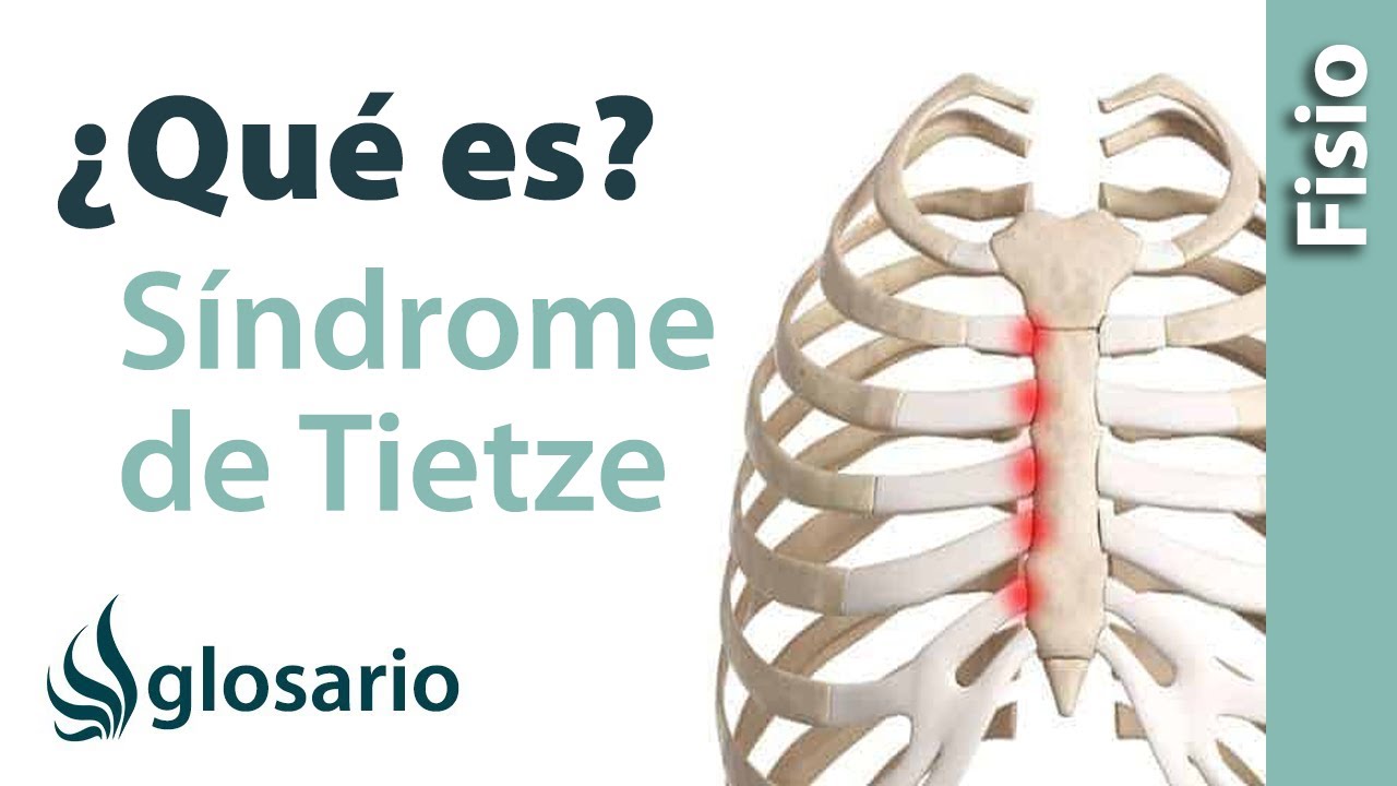 Síndrome De Tietze Sintomas - RETOEDU