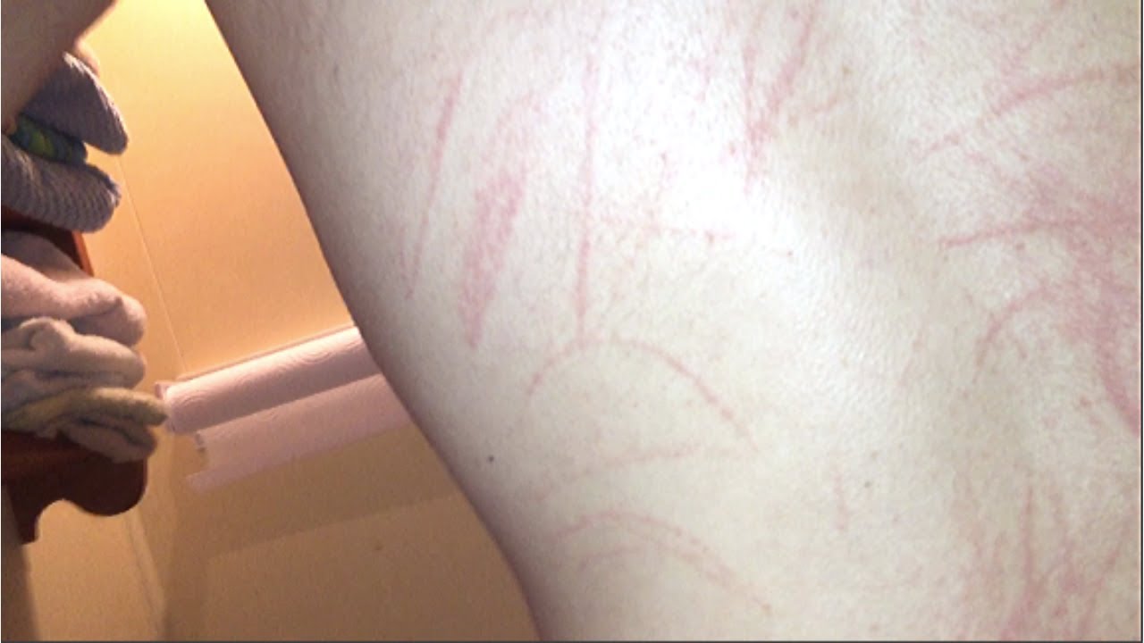WARNING I Developed A Strange Rash From Eating Raw Mushrooms warning-i-developed-a-strange-rash-from-eating-raw-mushrooms