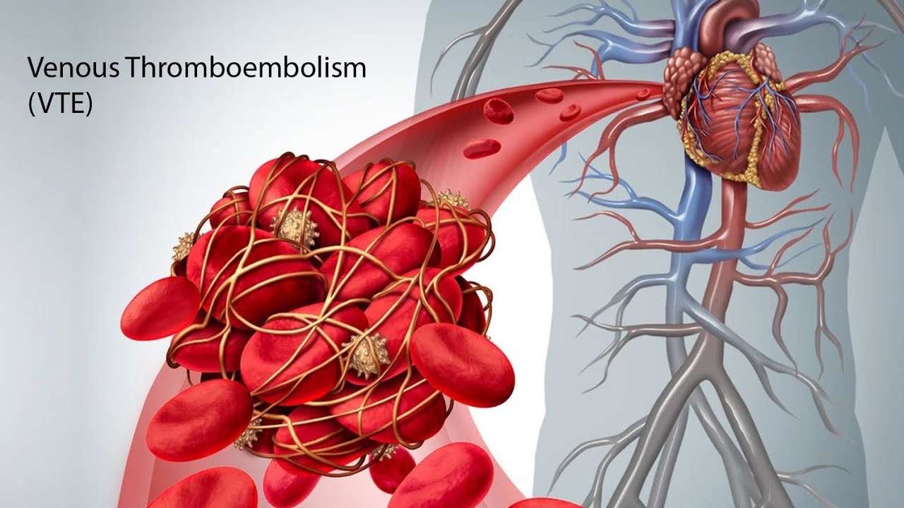 Venous Thromboembolism (VTE) Causes,Signs,Symptoms - YouTube