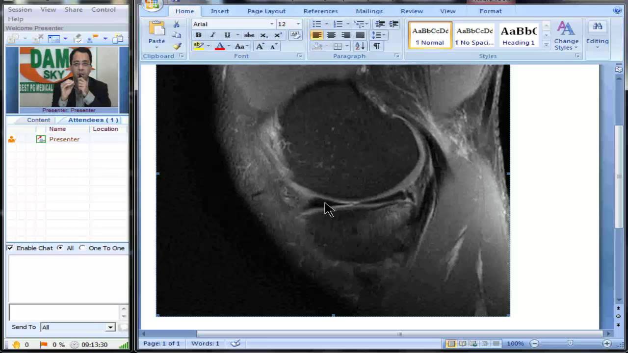 Radiology Spotters Part 6 Meniscal Flounce - YouTube