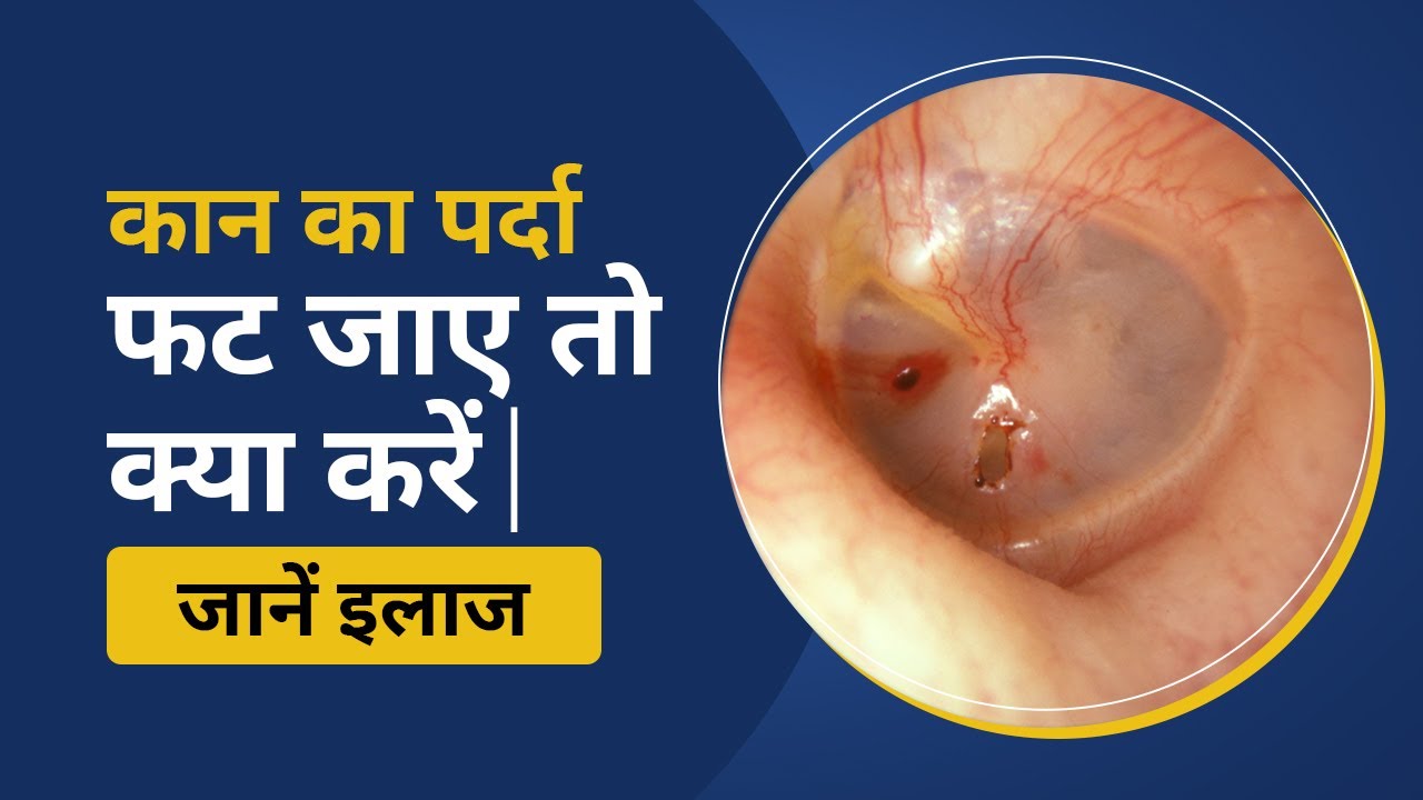 Hole in Ear Drum | कान का पर्दा फटना | Perforated Eardrum Treatment ...