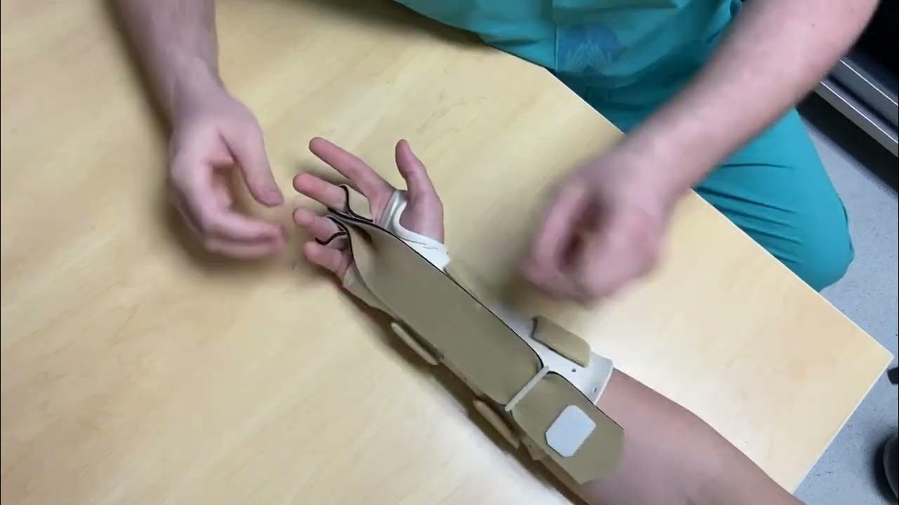 Simplified Dynamic Mcp Flexion Splint Youtube