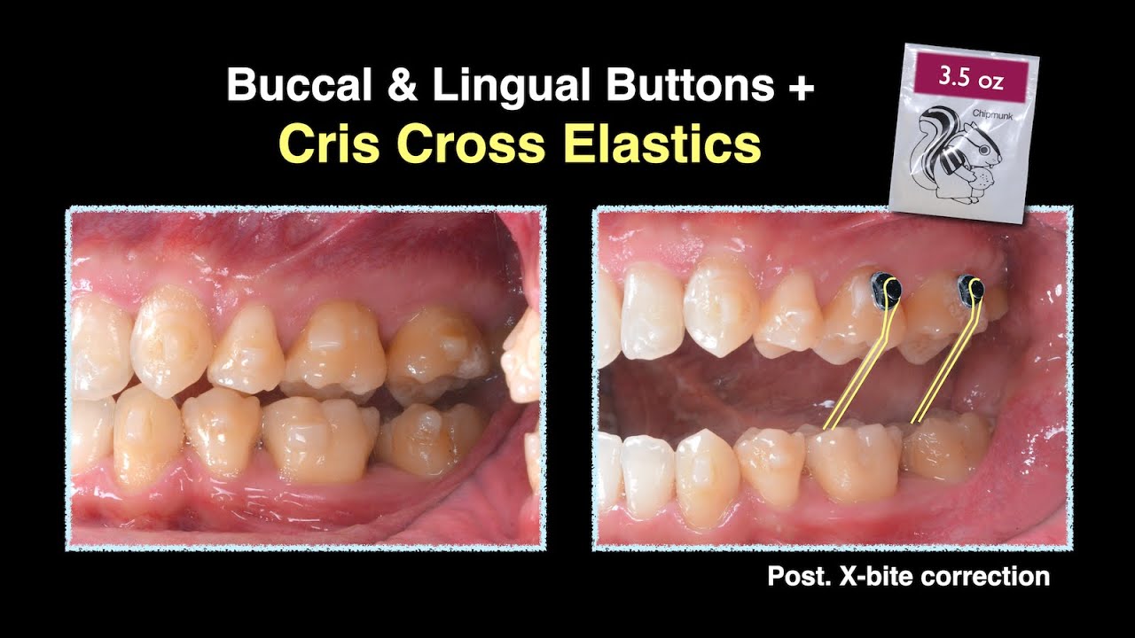 Crowding & Posterior cross bite Aligner｜【Chris Chang Ortho】CC811 - YouTube