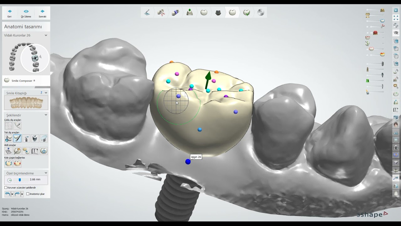 implant üstü vidalı diş tasarımı 3shape ile (Straumann) - YouTube