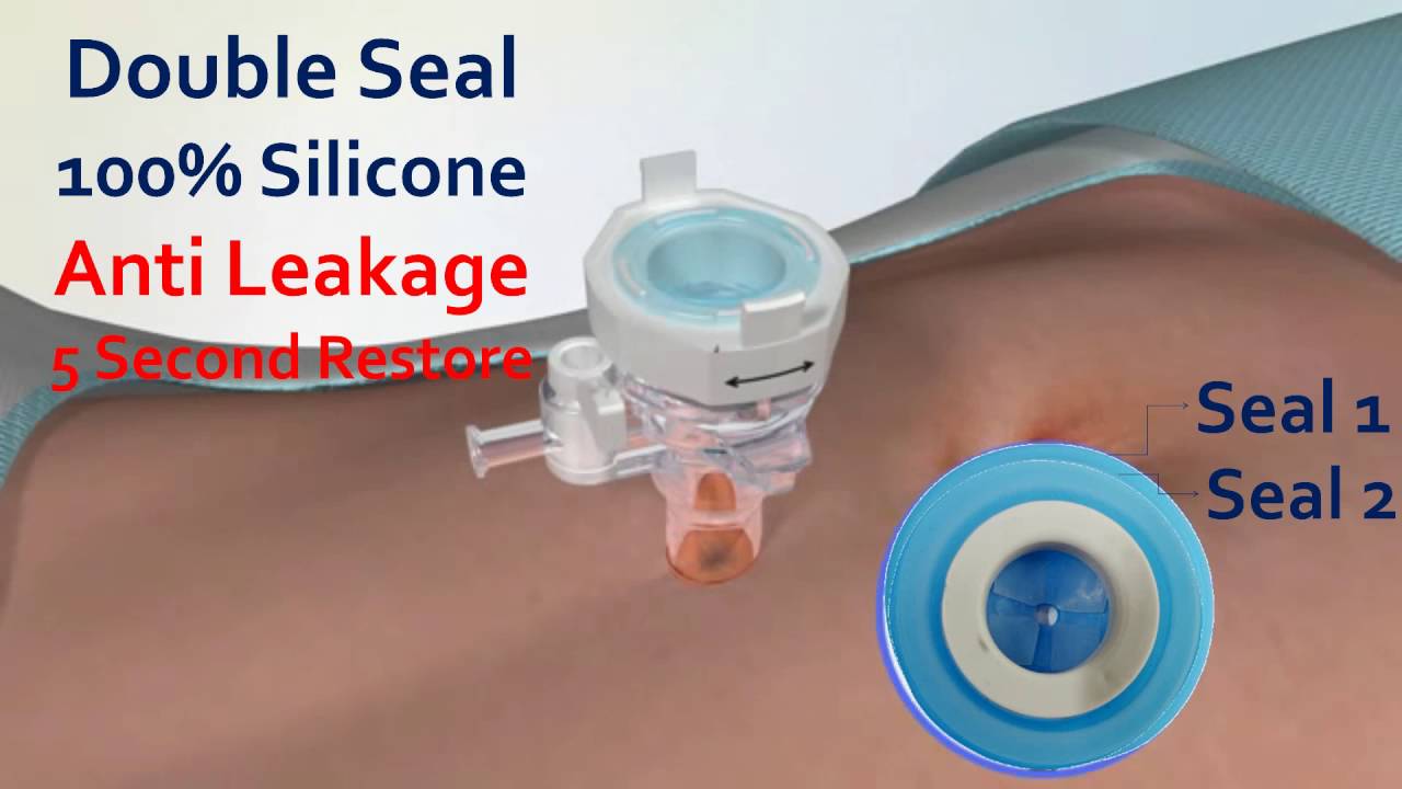5 FEATURES TROCAR LAPAROSCOPIC YOU SHOUD KNOW - YouTube