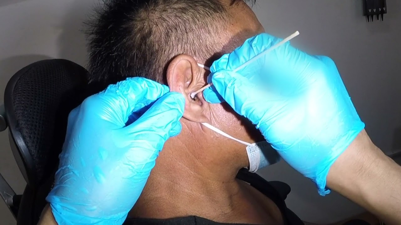 Chocolate stuck in ear removed - YouTube